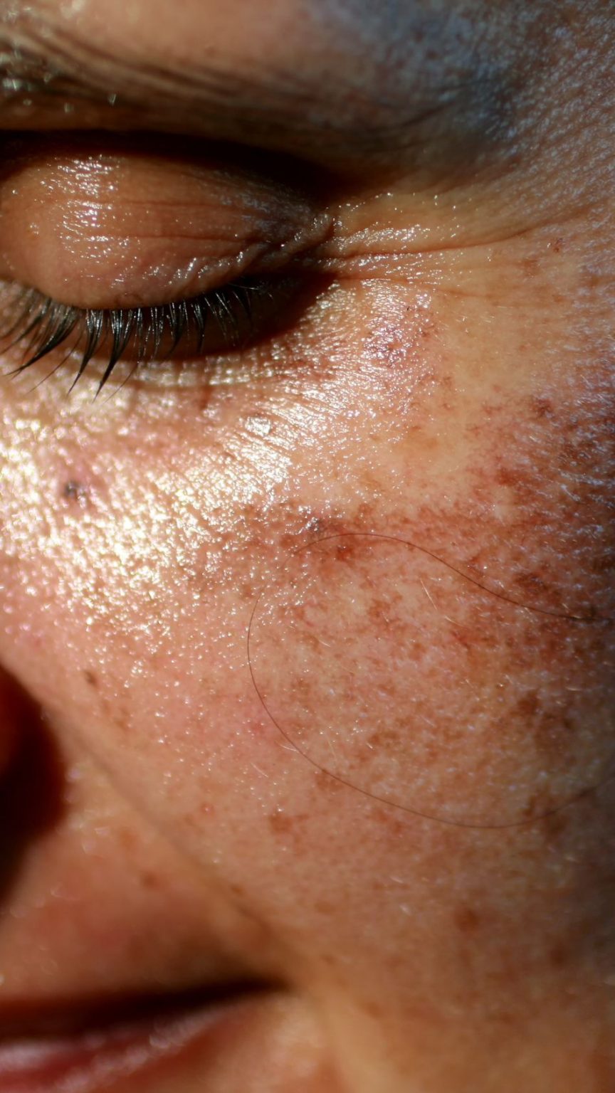 Hyperpigmentation – Lueur Aesthetic Clinic
