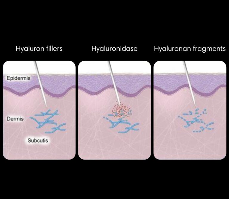 Filler dissolving – Lueur Aesthetic Clinic